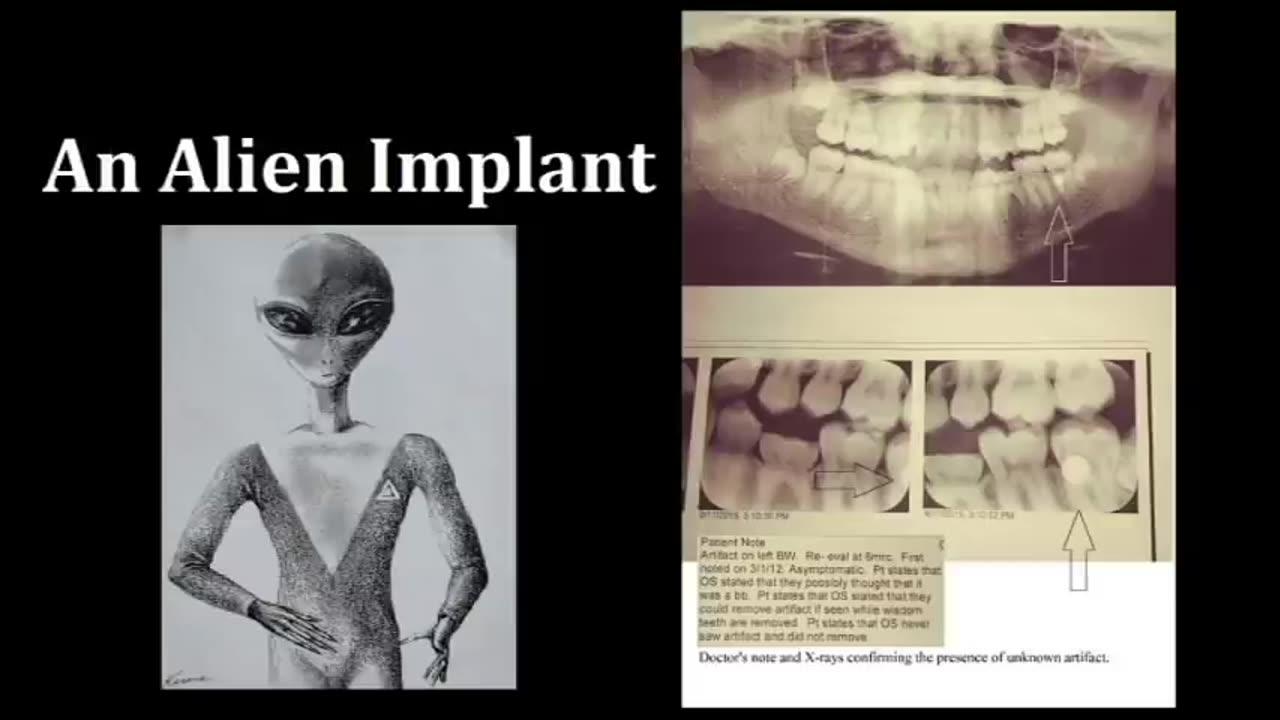 An Alien Implant - One News Page VIDEO