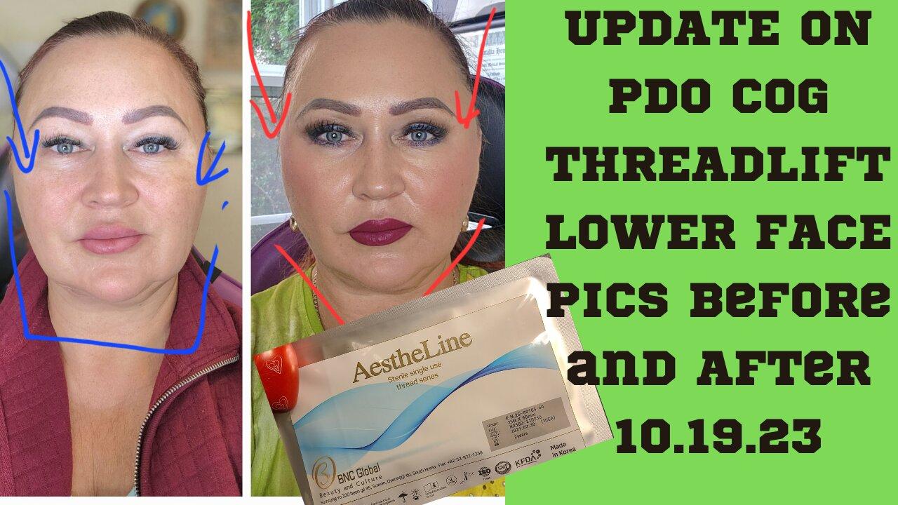 UPDATES PDO COGS THREADLIFT LOWER FACE BEFORE - One News Page VIDEO