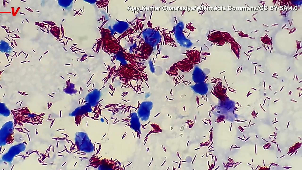 Leprosy Cases on the Rise in the US and Doctors - One News Page VIDEO
