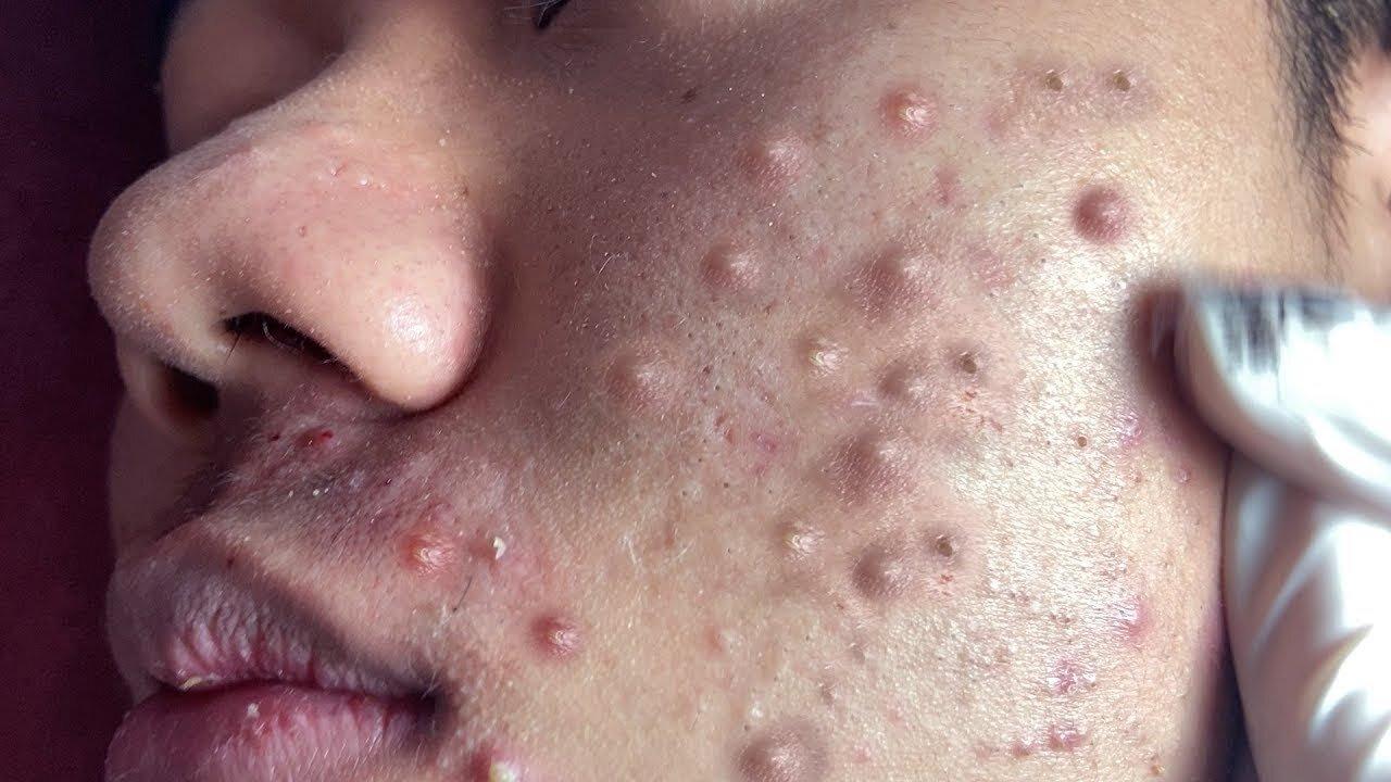 Big Cystic Acne Blackheads Extraction Blackheads - One News Page VIDEO