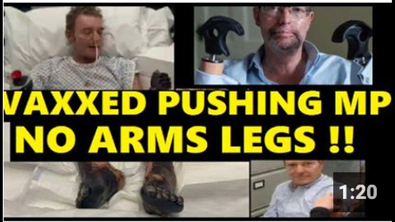 VAX MP NO ARMS OR LEGS, CUT OFF!! - One News Page VIDEO